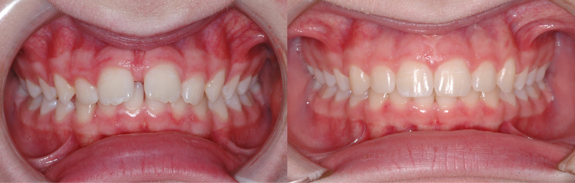 Smile Gallery - Fargo Orthodontics - Orthodontics Fargo